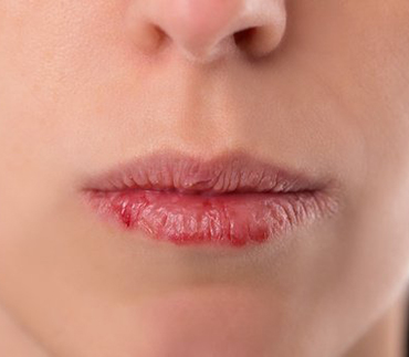 Oropharynxkarzinom Symptome Die Jeder Kennen Sollte